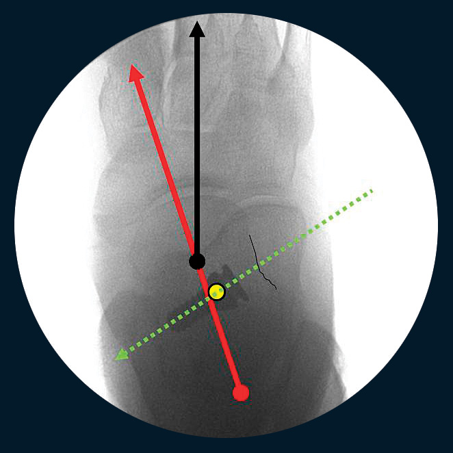 Hyperpronation - very common feet problem nowadays.